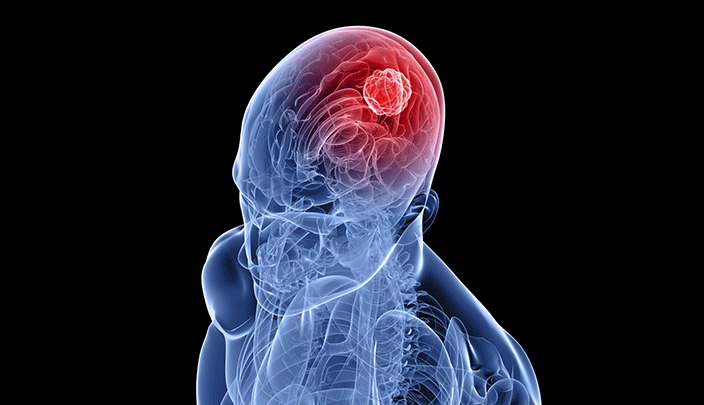 دراسة مثيرة للحيرة تربط الشهادة الجامعية بأورام المخ.. ماذا عن النساء؟