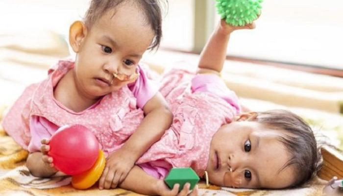فصل توأم ملتصق بعد جراحة استمرت 6 ساعات