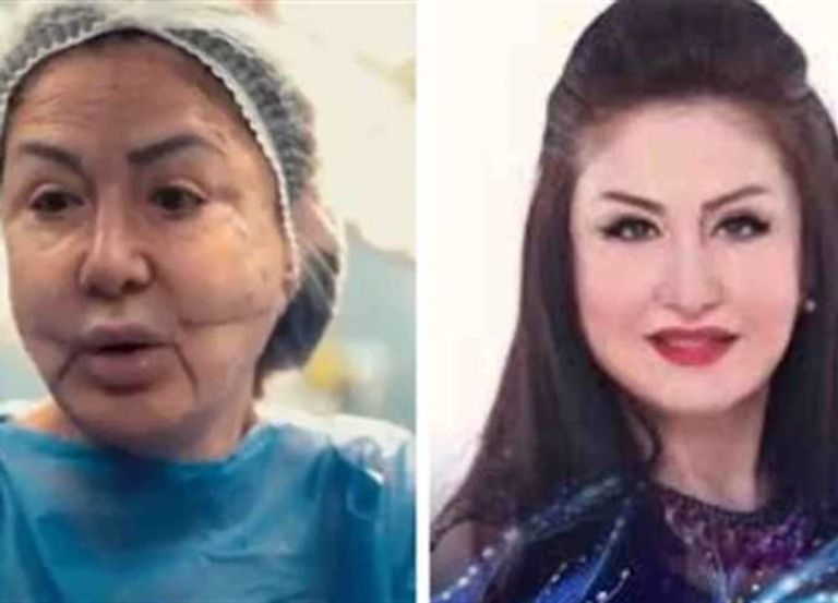 قبل ريهام سعيد فنانات سقطن في «فخ عمليات التجميل صور